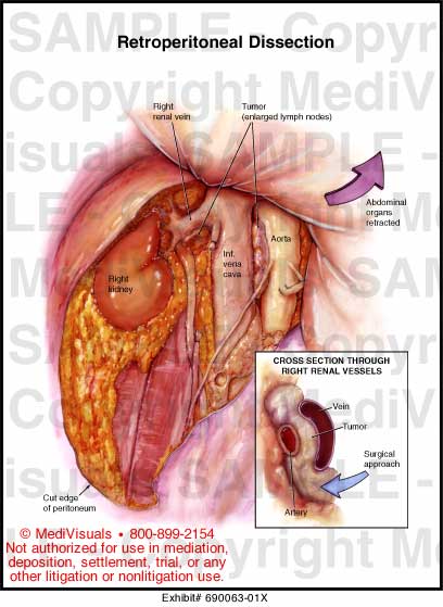 Medivisuals Retroperitoneal Dissection Medical Illustration